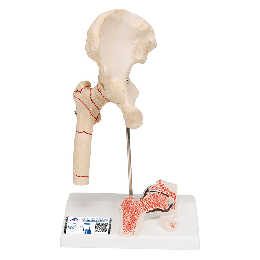 3B SCIENTIFIC Oberschenkelbruch und Hüftgelenkverschleiss (A88) | 3B1000175
